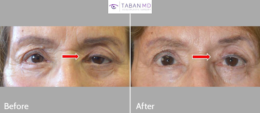 Revisional Eyelid Ptosis (Droopy Eyelid) Surgery | Dr. Mehryar (Ray ...