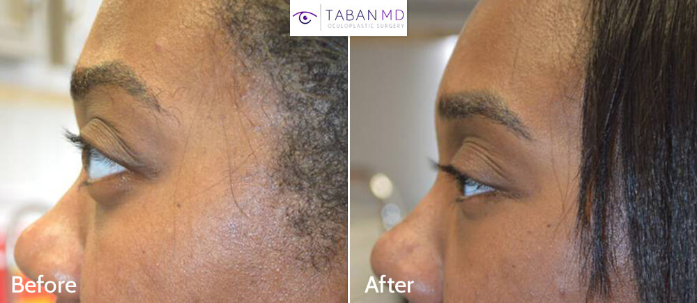 Eyelid Retraction Surgery | Dr. Mehryar (Ray) Taban MD Oculoplastic ...