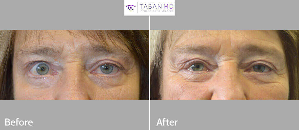 Eyelid Retraction Surgery Before and After Photos | Taban MD