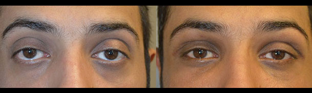 Almond Eye Surgery in Beverly Hills | Dr. Taban Almond Eye Specialist