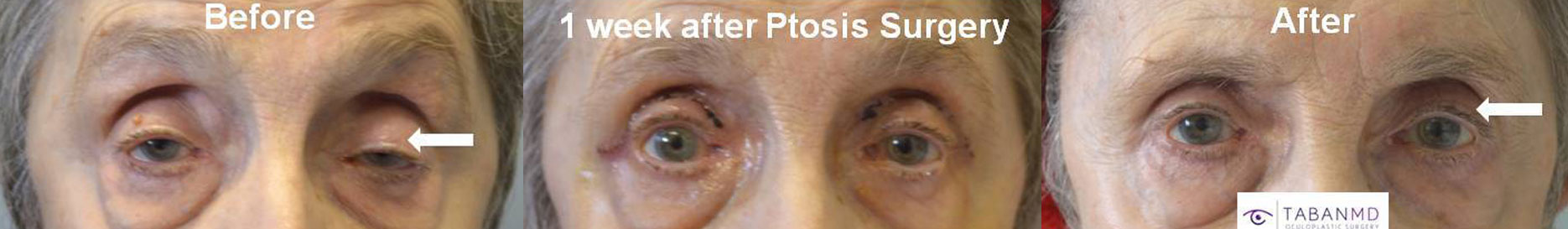 Ptosis Surgery Beverly Hills | Droopy Eyelid Surgery Los Angeles
