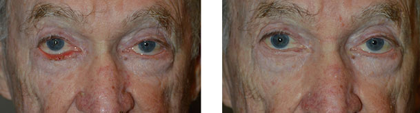 Eyelid Ectropion Surgery Treatment Specialists | Beverly Hills