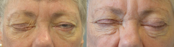 Facial Eyelid Paralysis Bell's Palsy Treatment Los Angeles