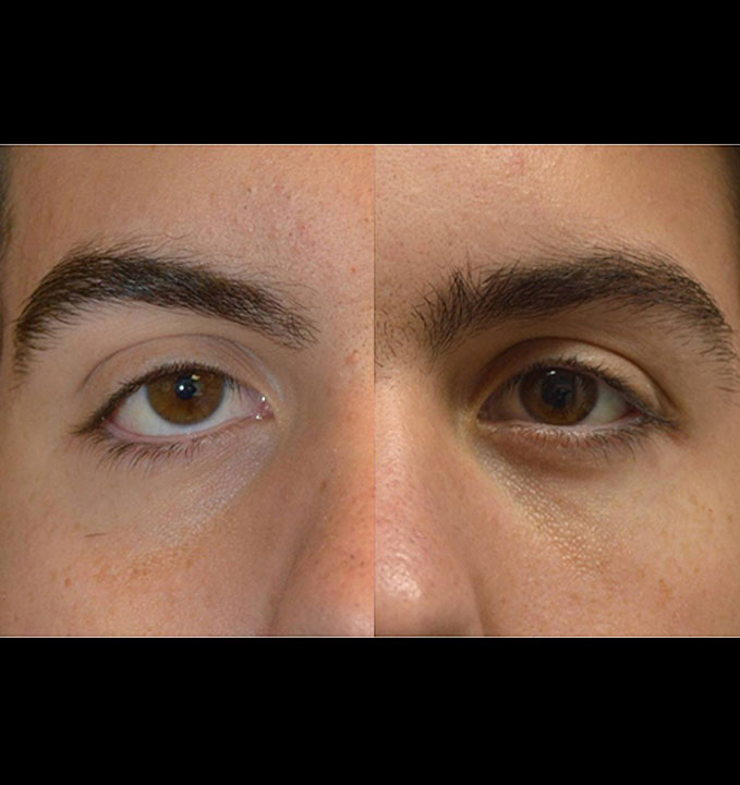 Beverly Hills Eyelid Retraction | Graves Disease Treatment