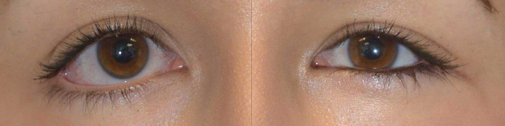 Beverly Hills Eyelid Retraction | Graves Disease Treatment