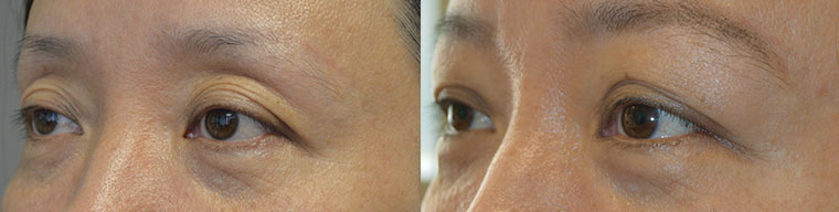 Cosmetic Filler Injection - Eyelid Filler Expert Beverly Hills