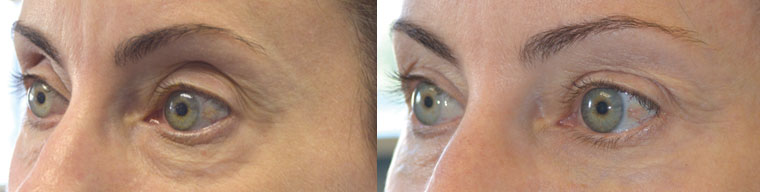Cosmetic Filler Injection - Eyelid Filler Expert Beverly Hills