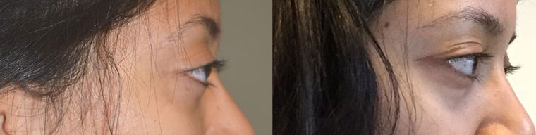 Orbital Decompression Surgery Beverly Hills - Bulgy Eye Surgery | Taban